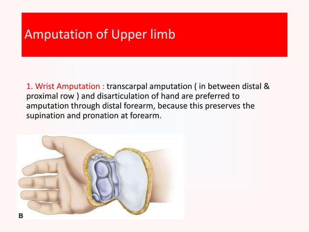 Amputation and disarticulation | PPTX | Death, Injury, or Military ...