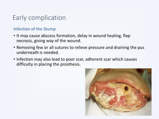 Amputation and disarticulation | PPTX