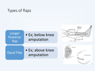 Amputation and disarticulation | PPTX