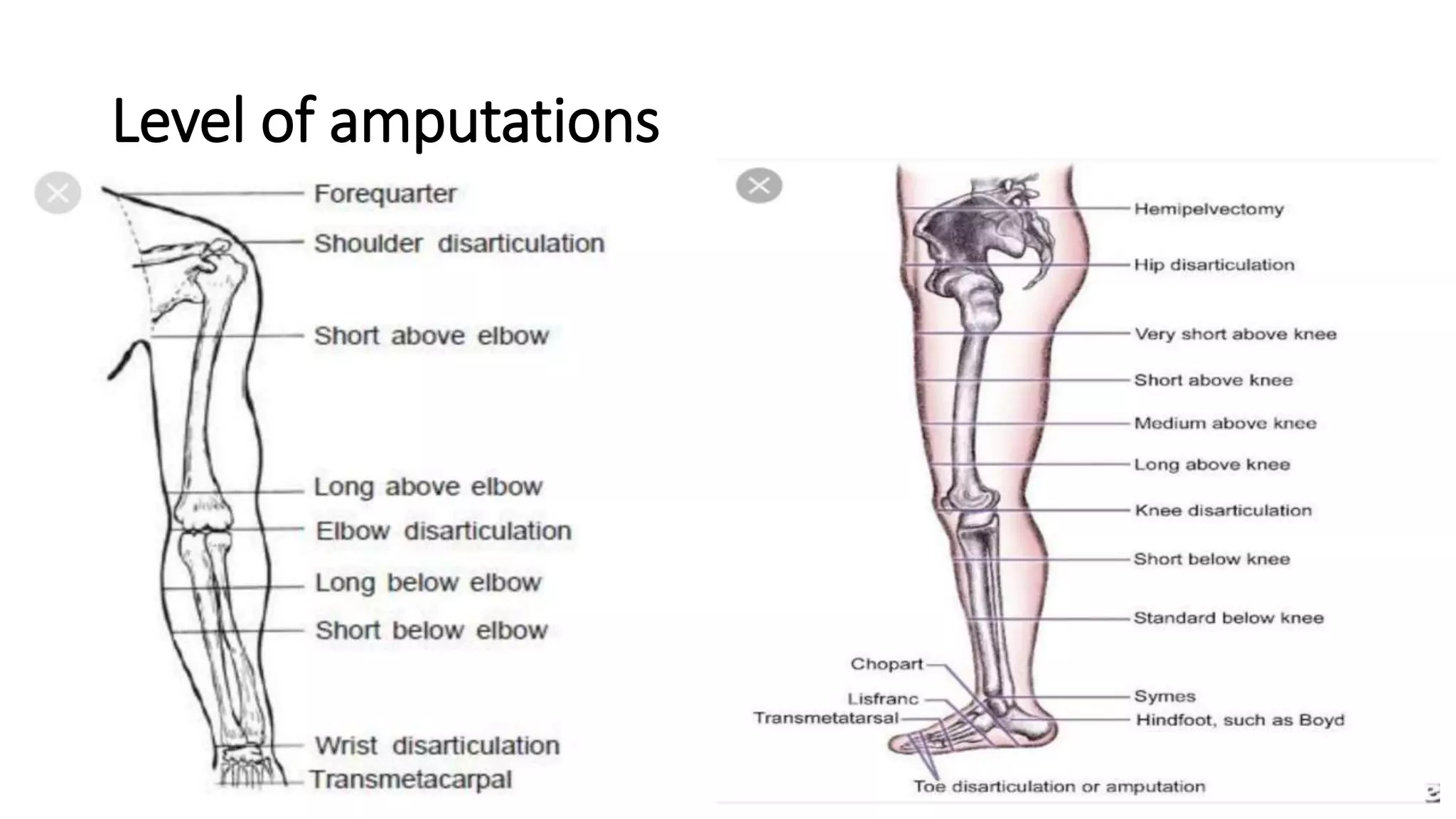 Amputation and Prosthesis | PPTX