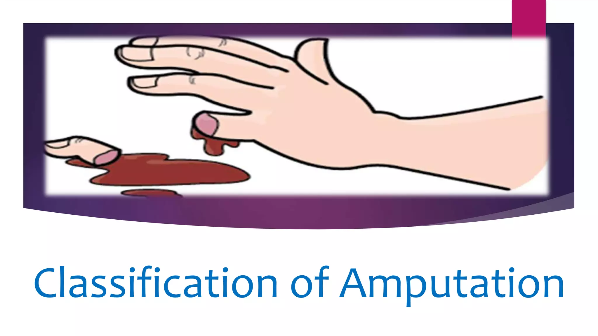 Amputation and prosthesis | PPTX