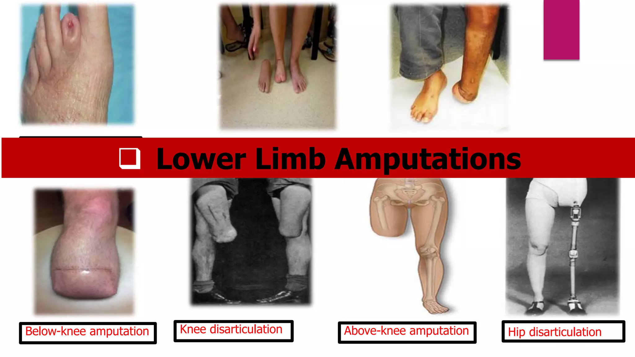 Amputation and prosthesis | PPTX