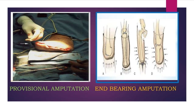 Amputation and prosthesis | PPTX