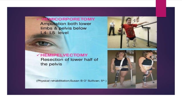 Amputation and prosthesis | PPTX