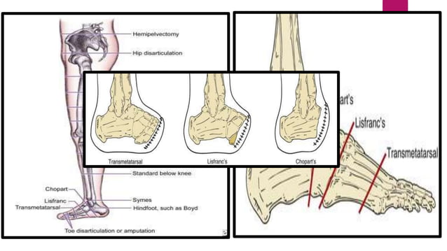 Amputation and prosthesis | PPTX