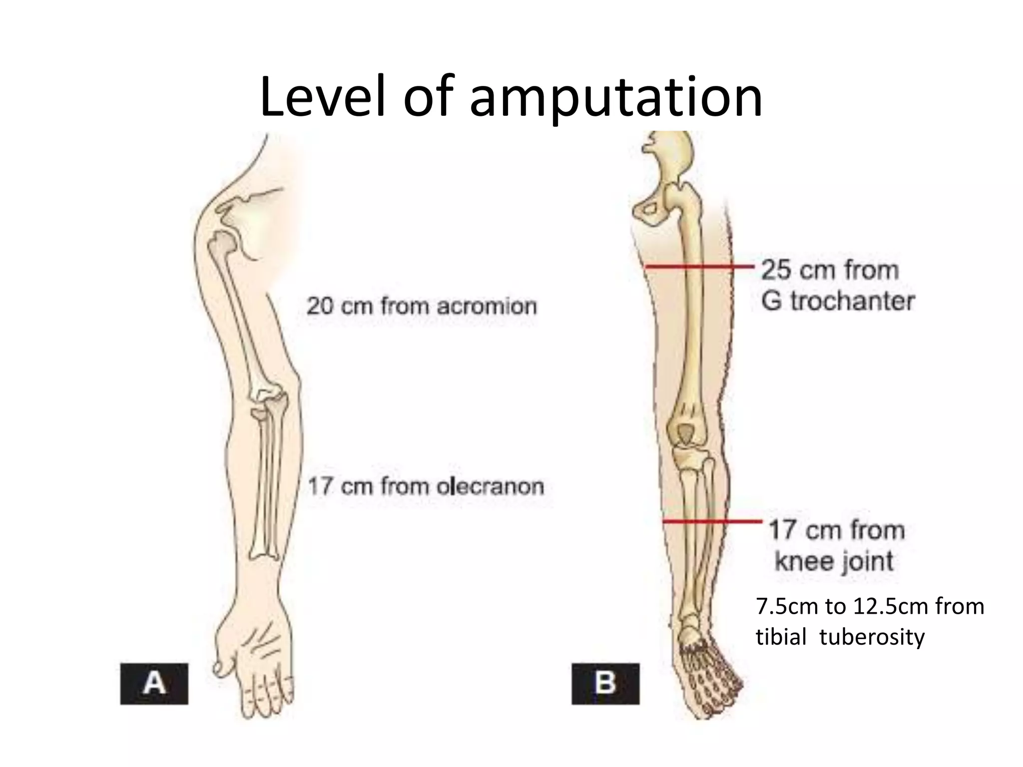 Amputation and rehabilitation | PPTX