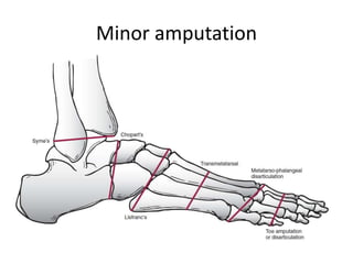 Amputation and rehabilitation | PPTX
