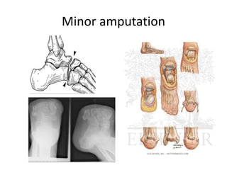 Amputation and rehabilitation | PPTX