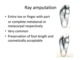 Amputation and rehabilitation | PPT