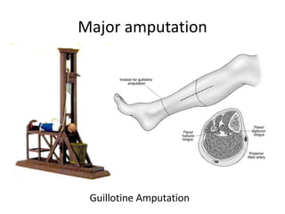 Amputation and rehabilitation | PPT