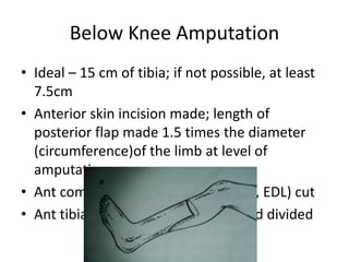 How Long Is Recovery From Below Knee Amputation