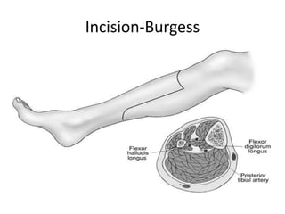 Amputation and rehabilitation | PPT