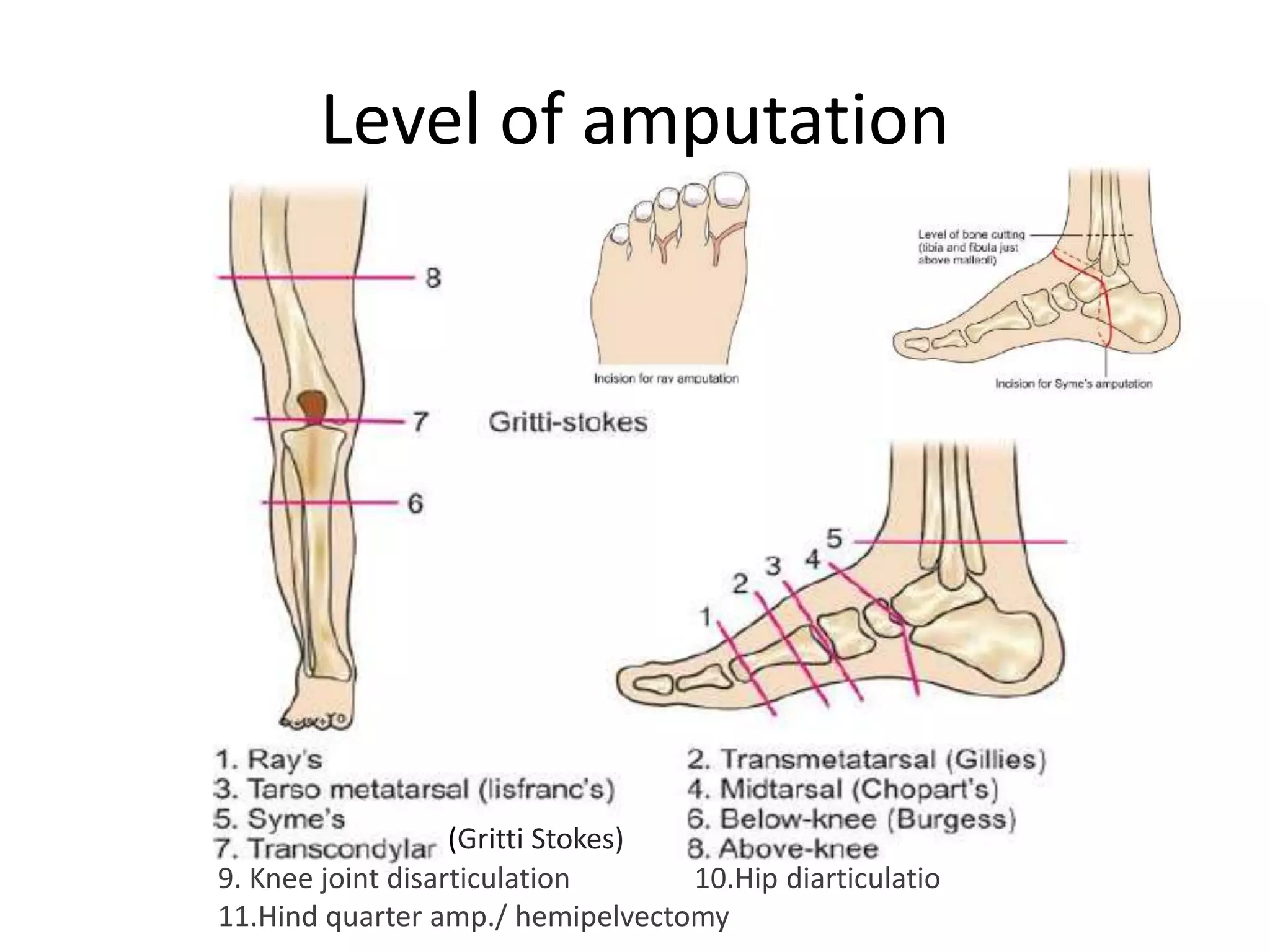 Amputation and Rehabilitation | PPTX