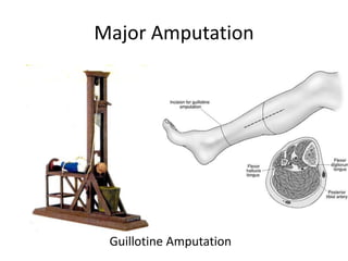 Amputation and Rehabilitation | PPT