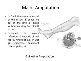 Amputation and Rehabilitation | PPT