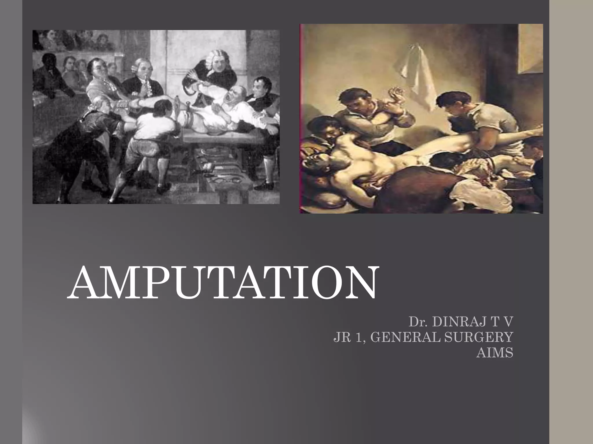 Amputationautosaved | PDF