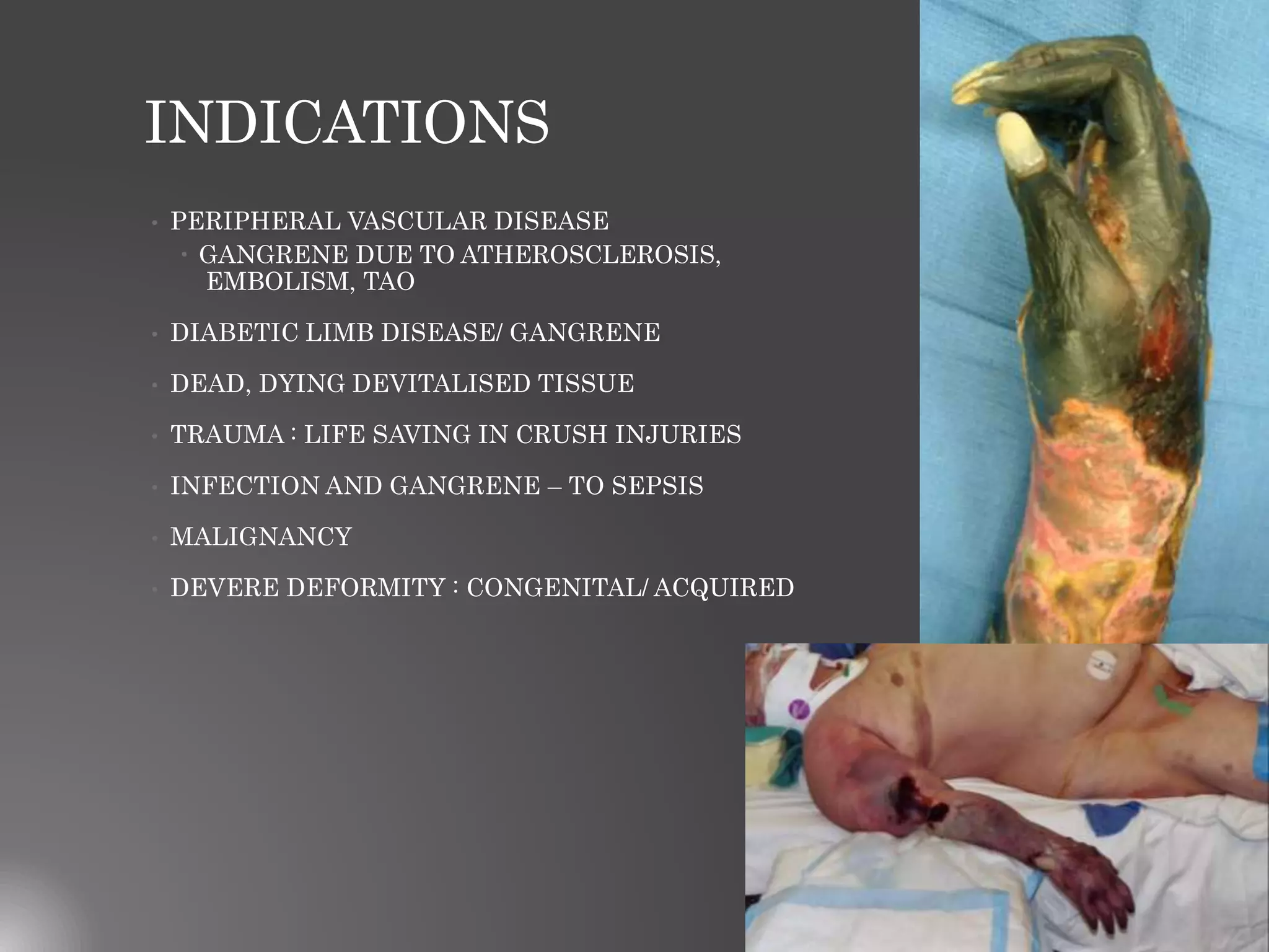 Amputationautosaved | PDF