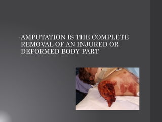 Amputationautosaved | PDF