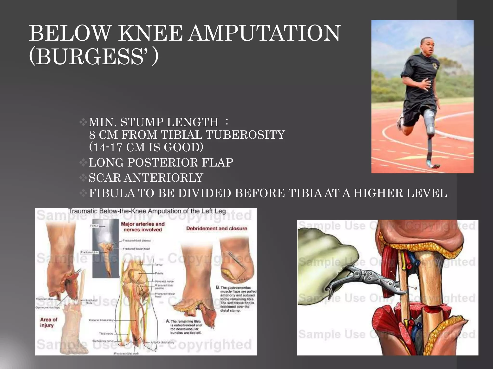 Amputations | PPTX
