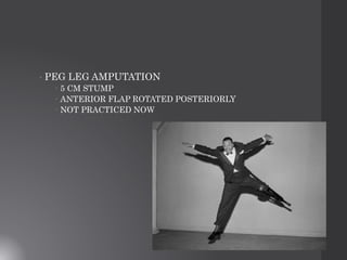 Amputations | PPTX