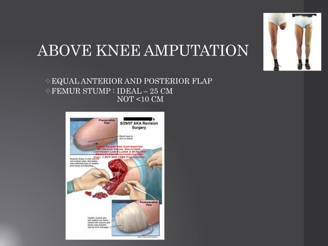 Amputations | PPTX | Death, Injury, or Military Conflict | Sensitive Topics