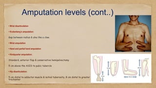 Amputation | PPTX