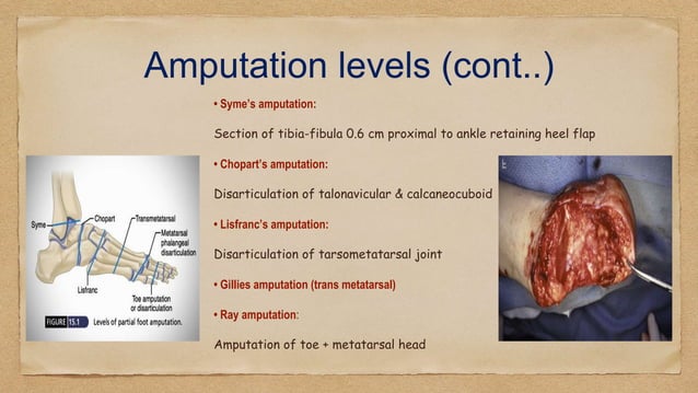 Amputation | PPTX