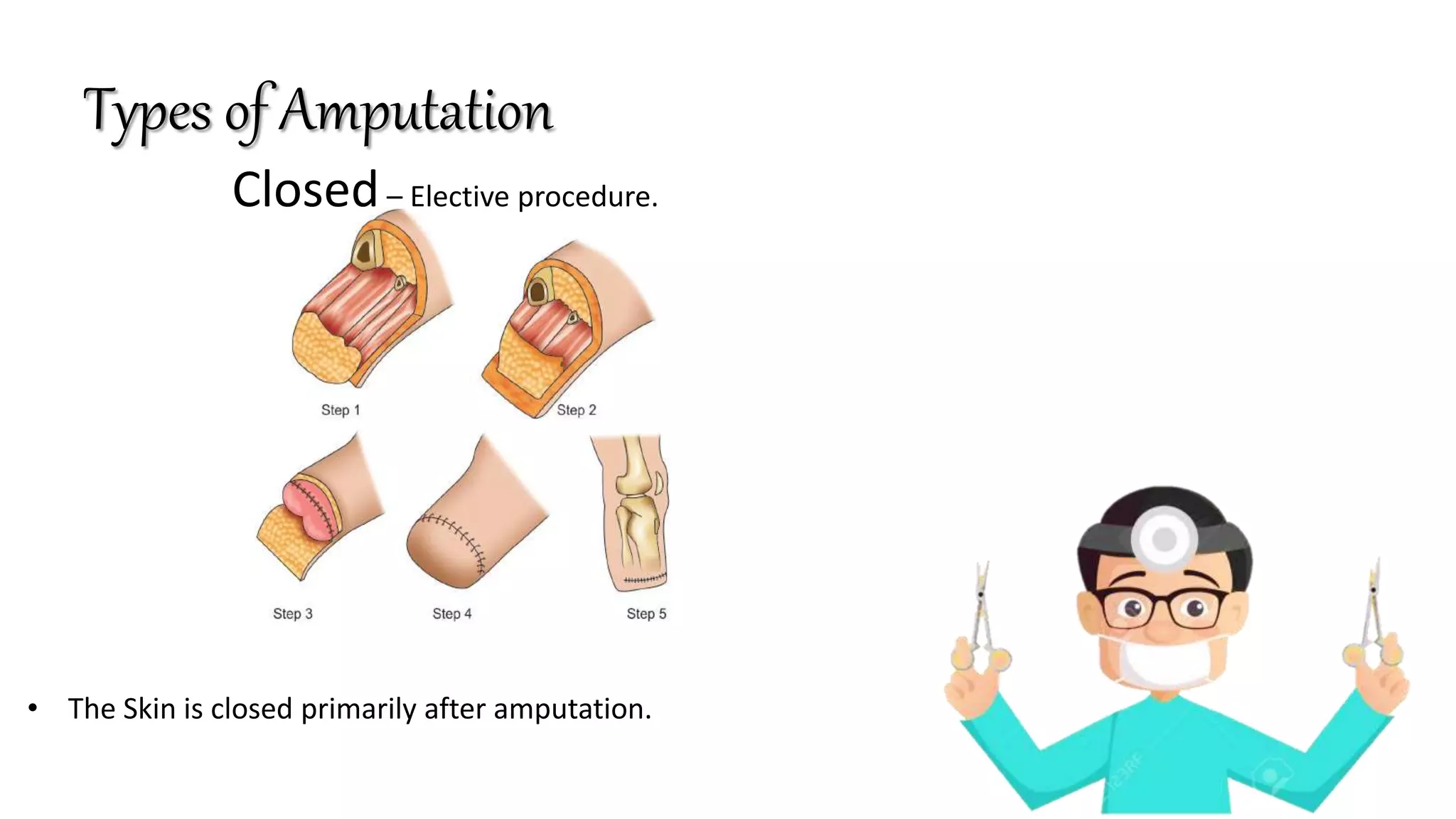 amputation final ppt.pptx