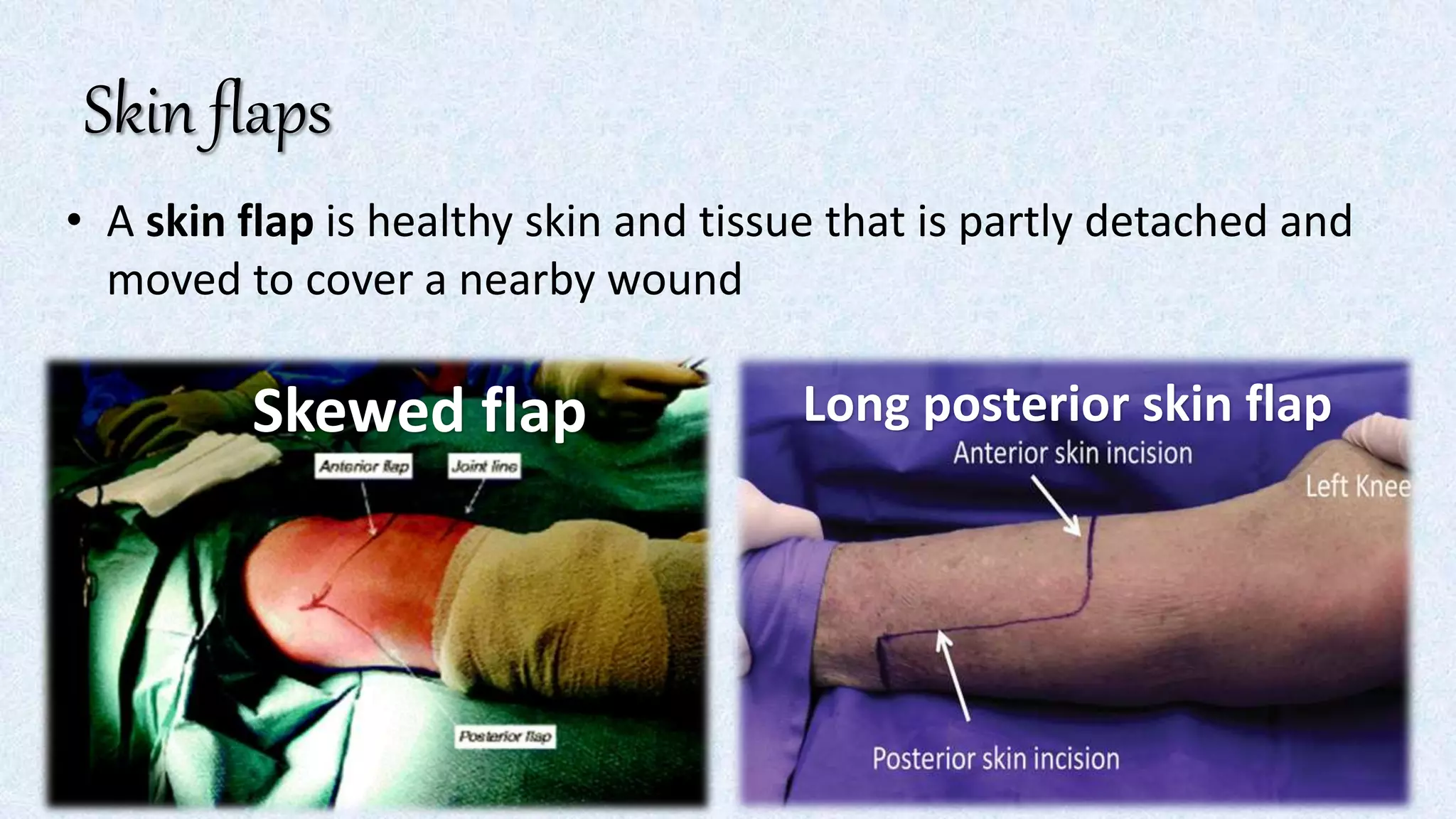 amputation final ppt.pptx