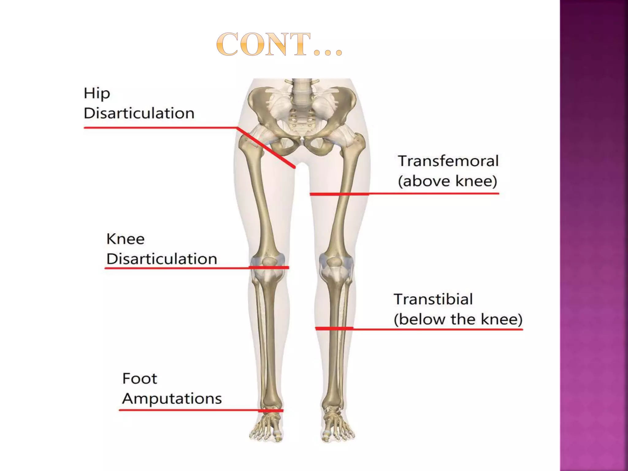 amputation final ppt (1).pptx