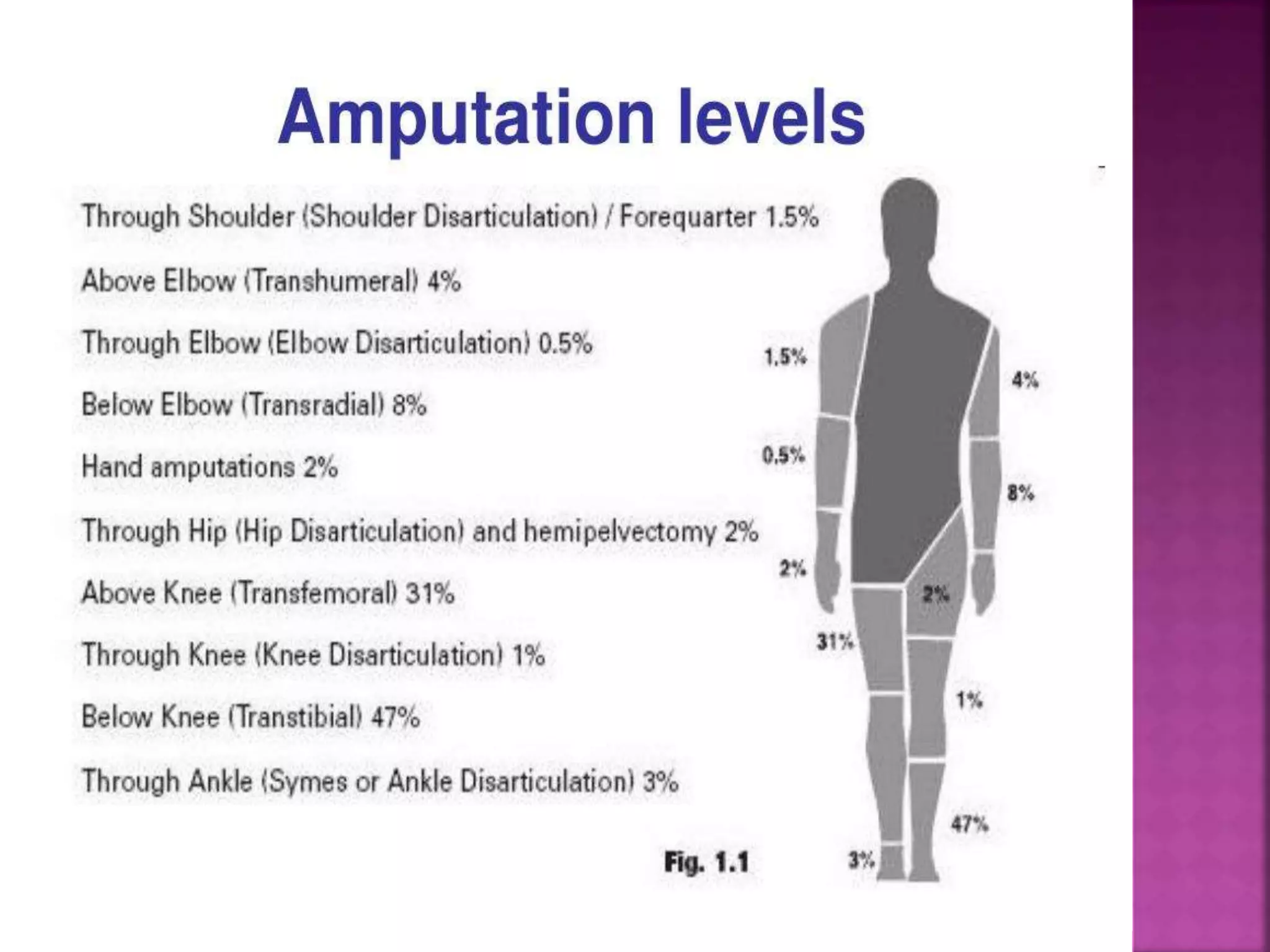amputation final ppt (1).pptx