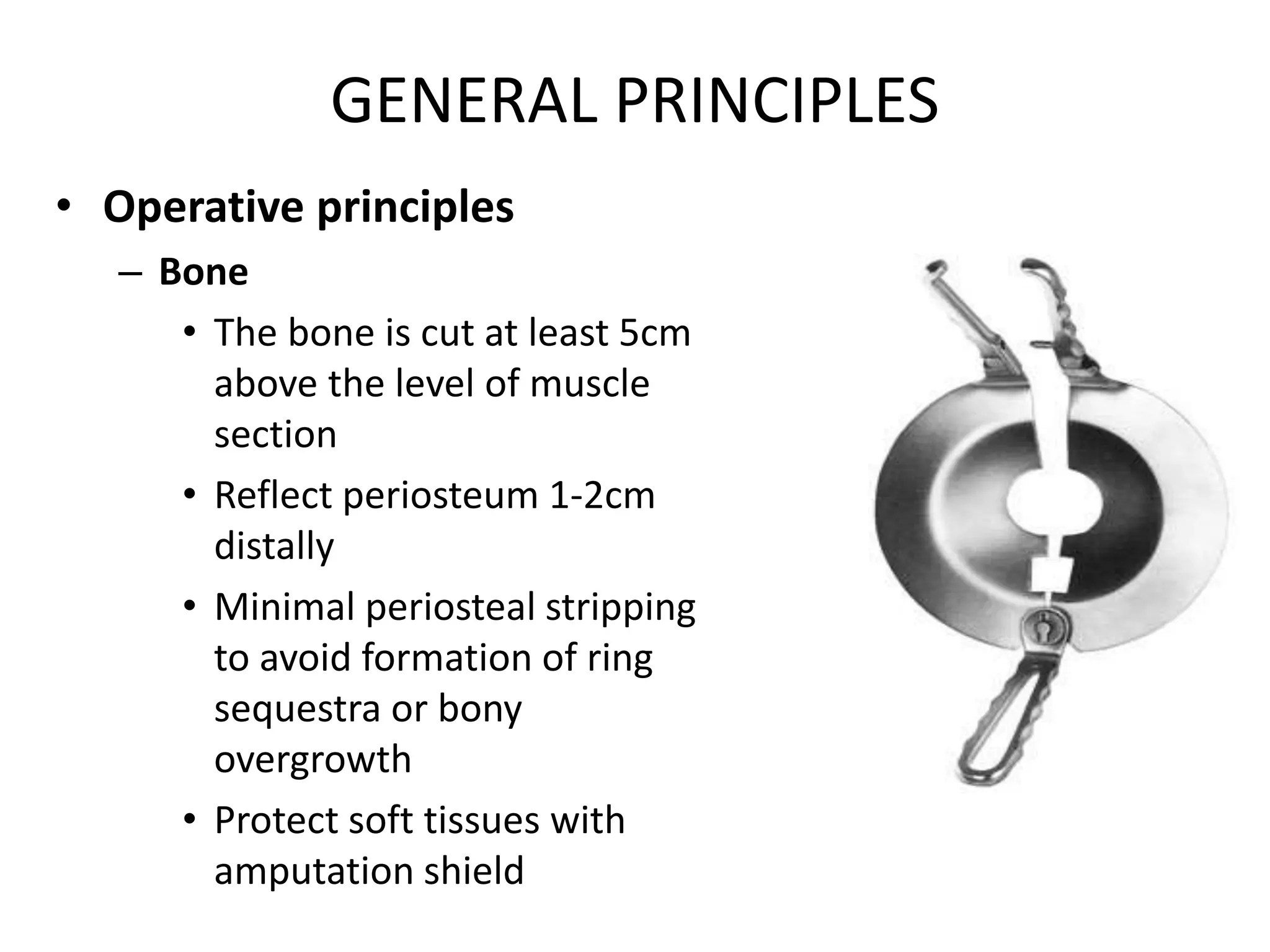 Amputation principles | PPTX