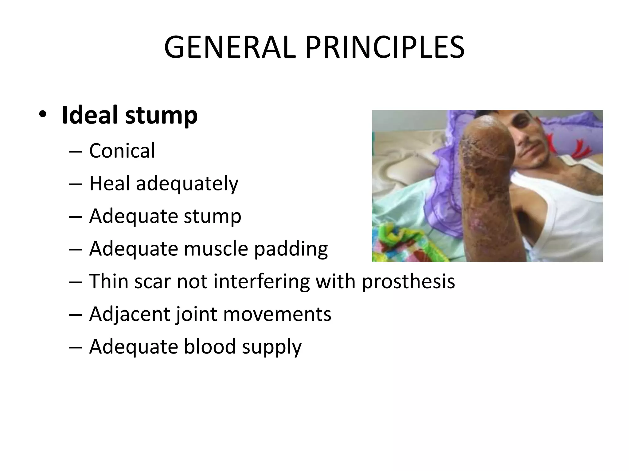 Amputation principles | PPTX