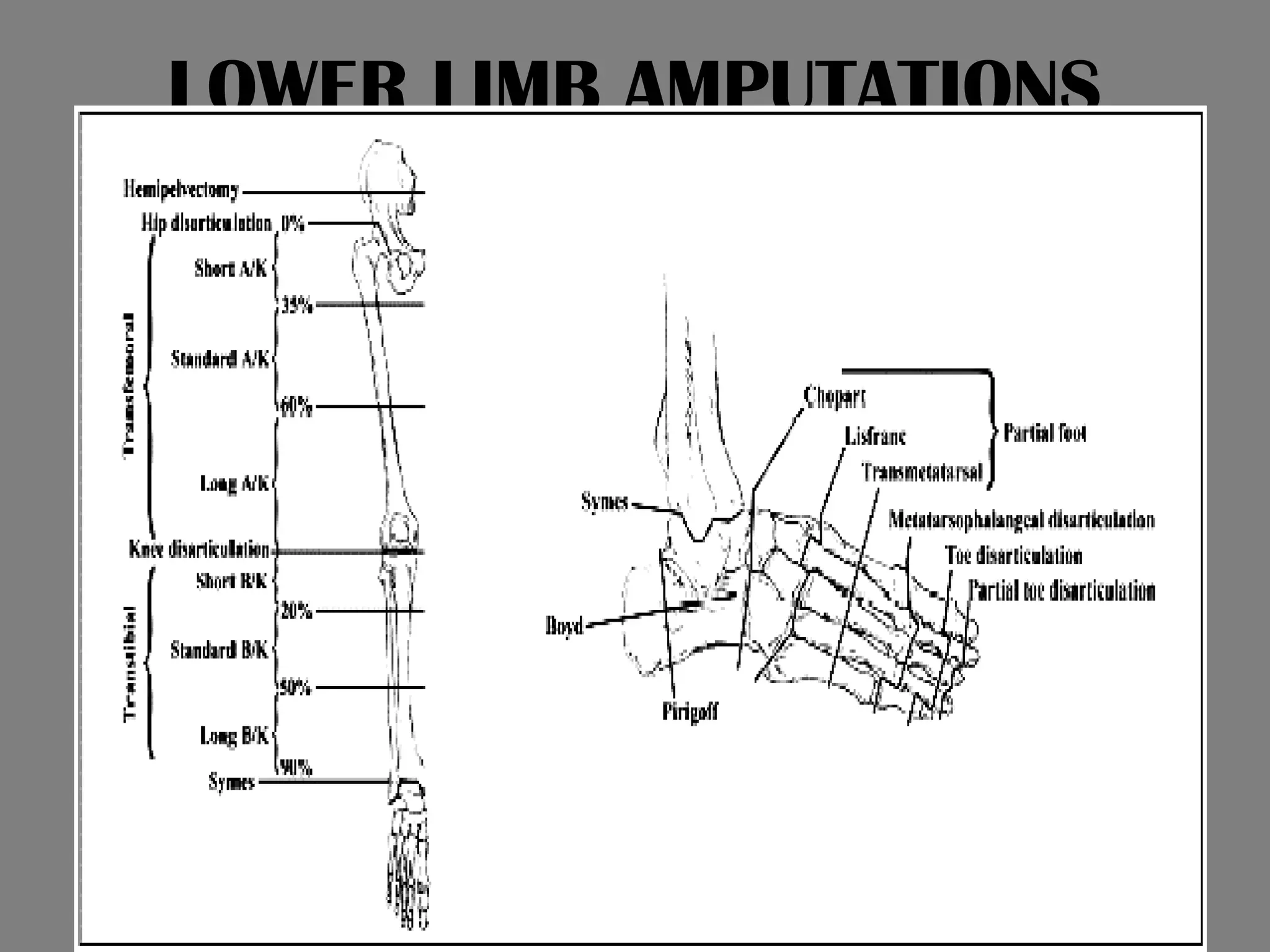 Amputations | PPT