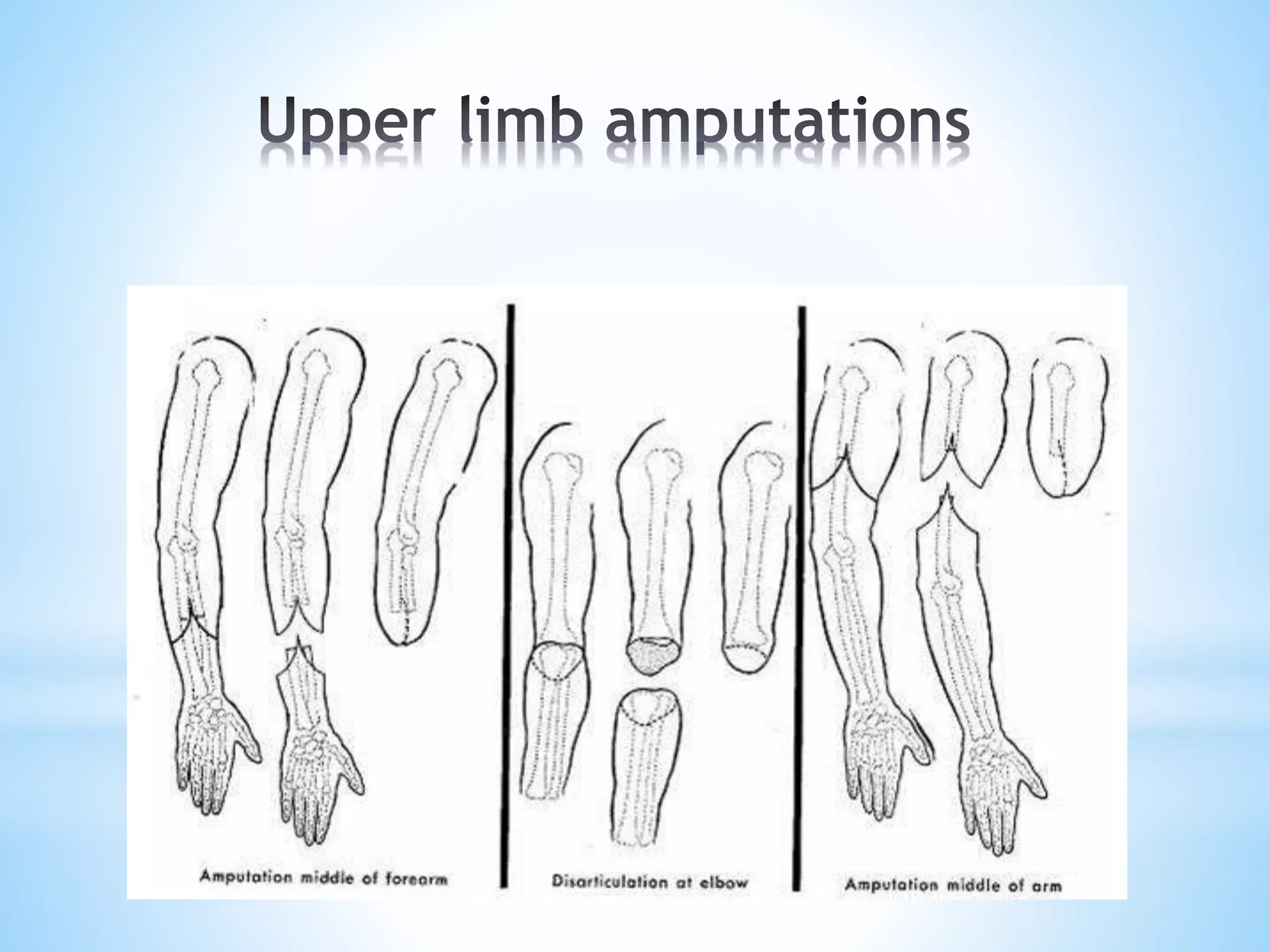 Amputations of extremity | PPTX