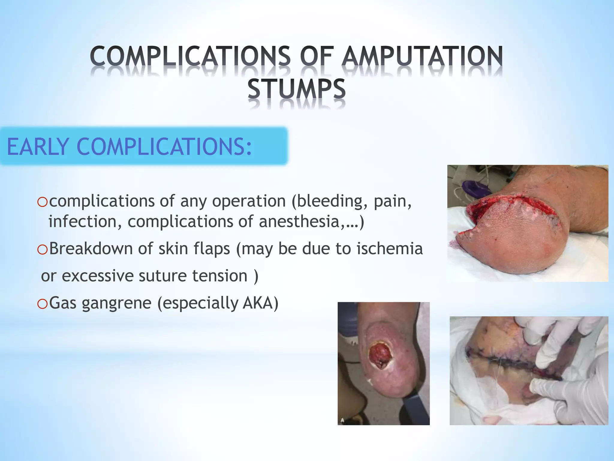 Amputations of extremity | PPTX