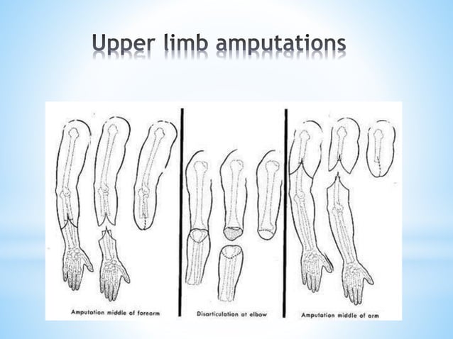 Amputations of extremity | PPTX | Injuries | Diseases and Conditions
