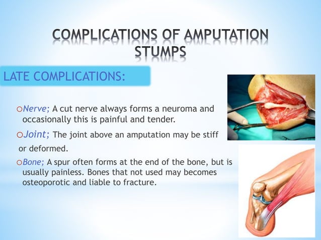 Amputations of extremity | PPTX | Injuries | Diseases and Conditions