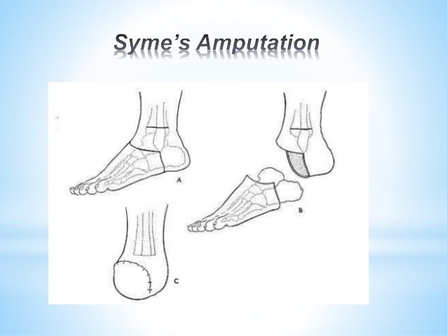 Amputations of extremity