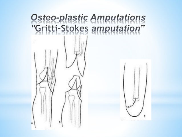 Amputations of extremity