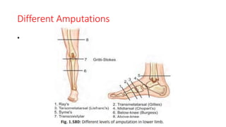 Amputations.pptx