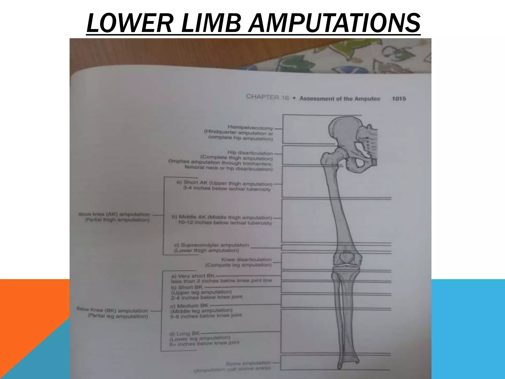 amputations.pptx