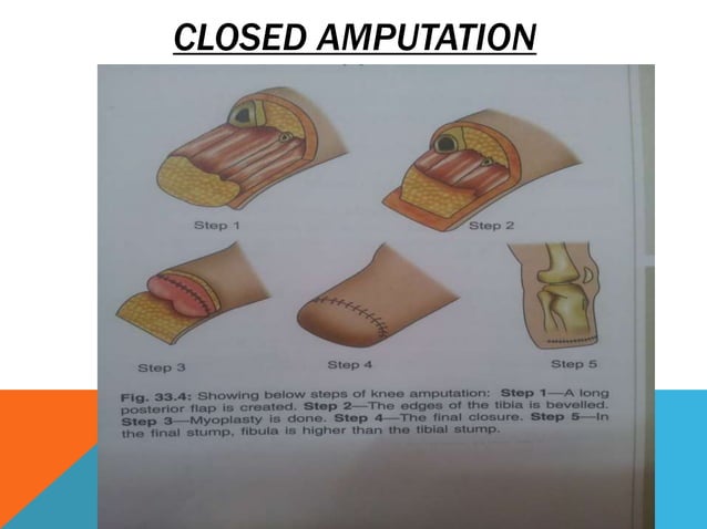 amputations.pptx | Death, Injury, or Military Conflict | Sensitive Topics