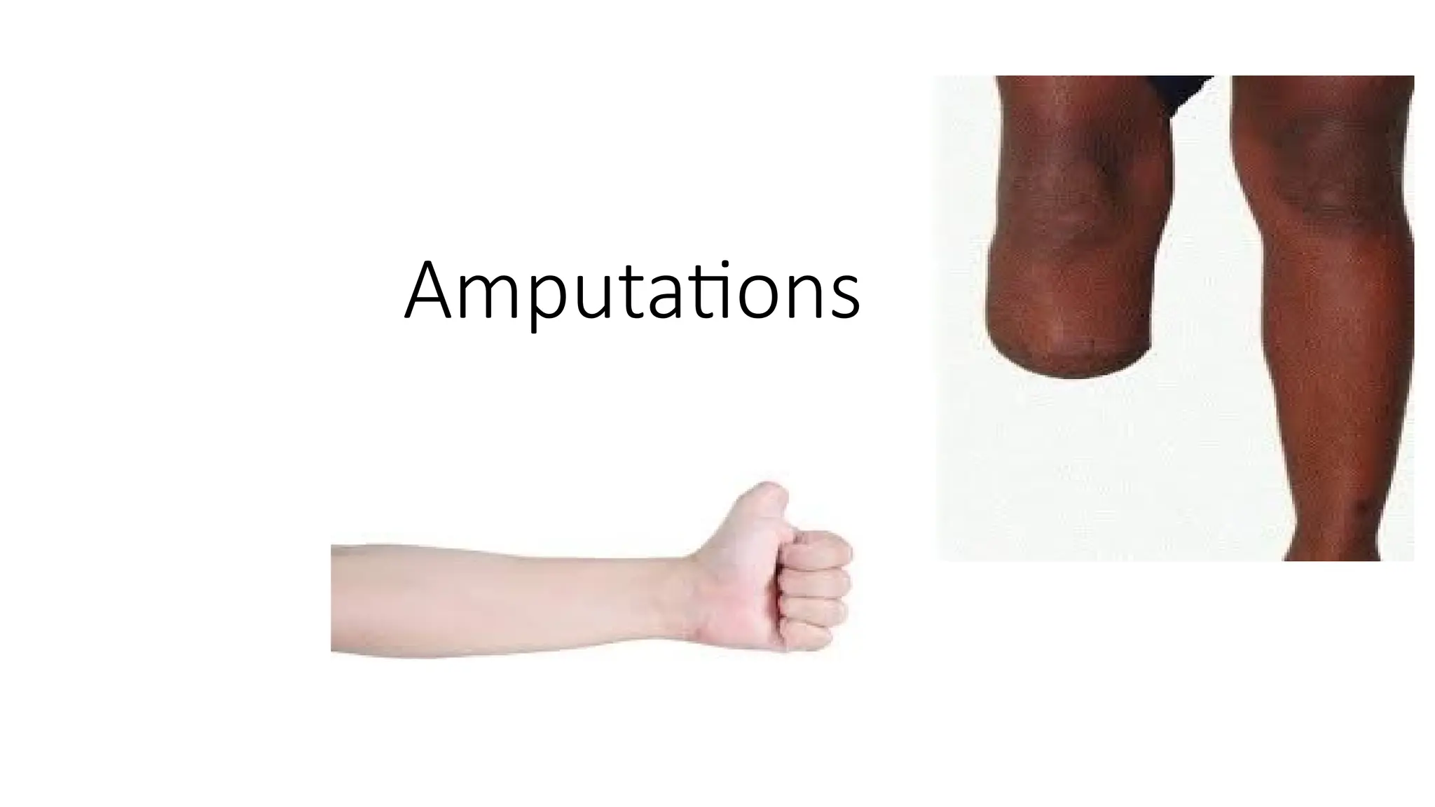 Amputations, types and levels , orthotics and prosthetics | PPTX