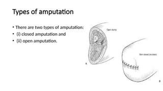 Amputations, types and levels , orthotics and prosthetics | PPTX