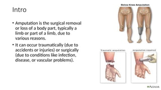 Amputations, types and levels , orthotics and prosthetics | PPTX