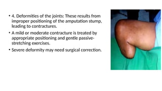 Amputations, types and levels , orthotics and prosthetics | PPTX