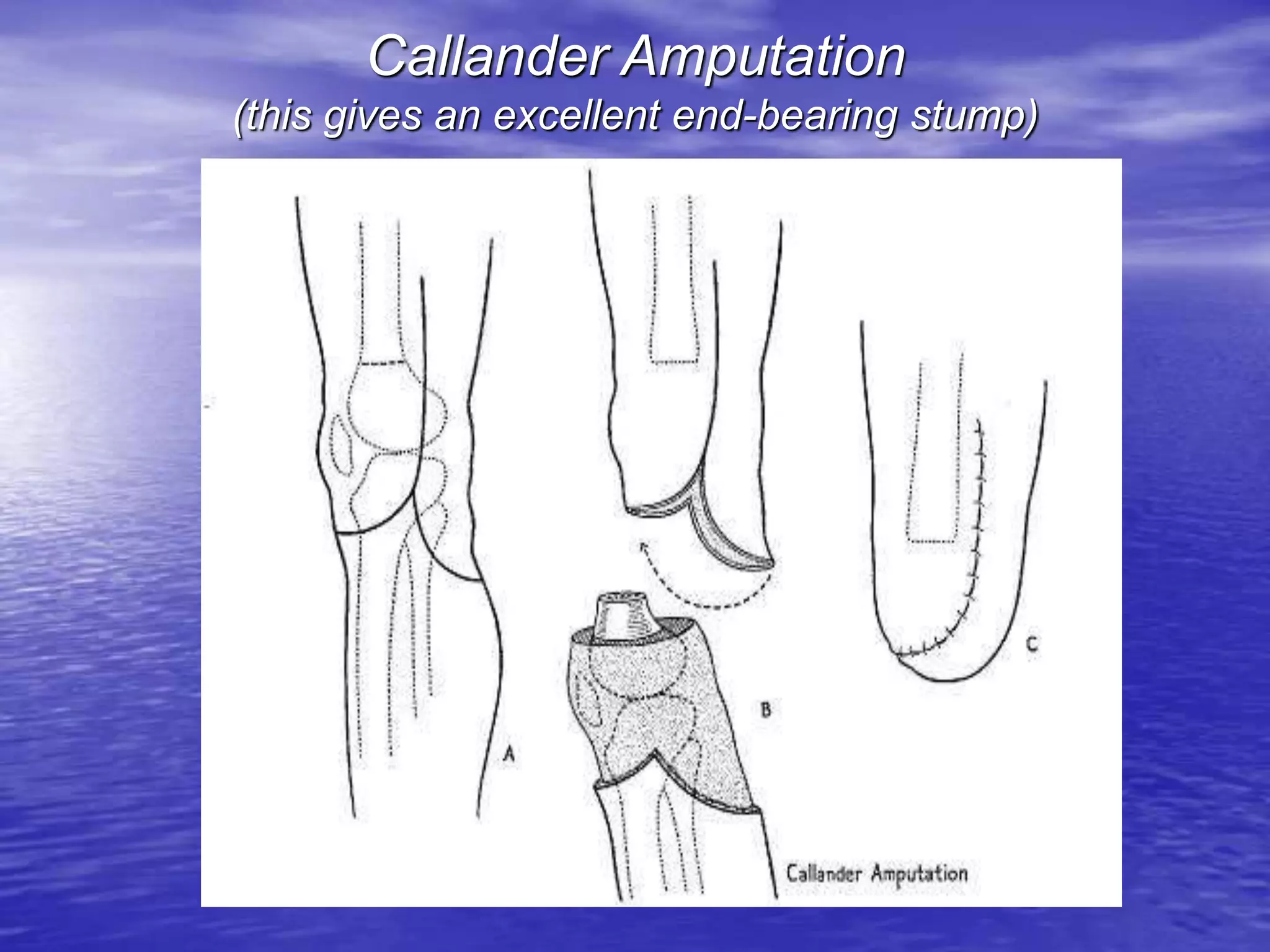 Amputations and disarticulations.ppt