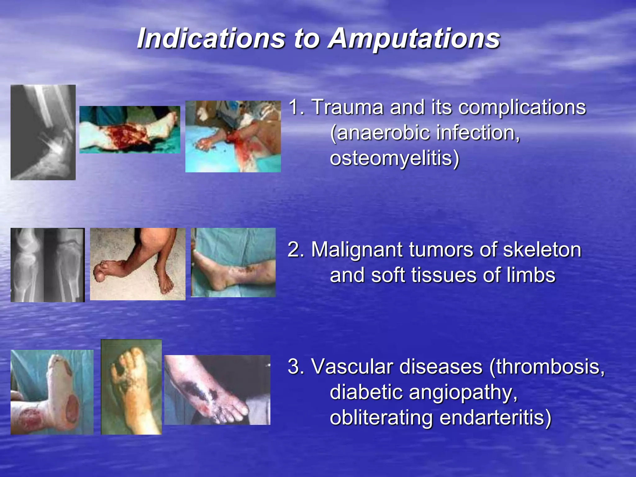 Amputations and disarticulations in limbs.ppt
