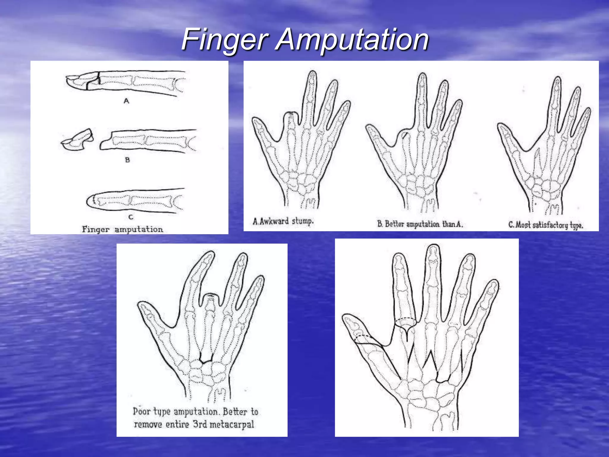 Amputations and disarticulations in limbs.ppt | Free Download